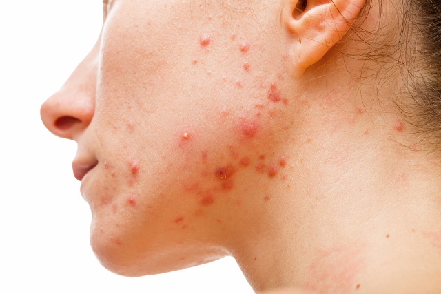 Acne - Peak Research